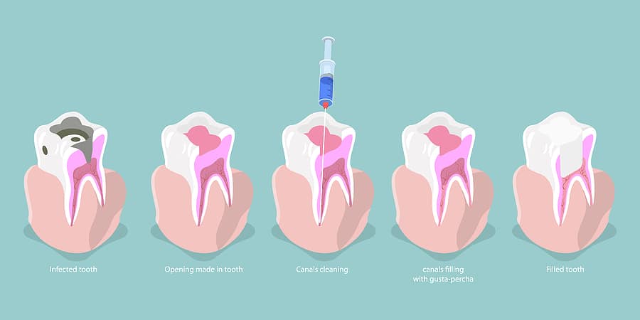 Understanding Root Canals: How to Tell If You Need One - Dentist in ...